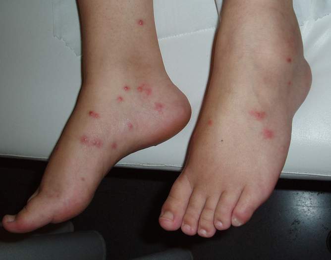 PICADA DE PERNILONGO, MOSQUITO - como parar de coçar ~ imagens para celular