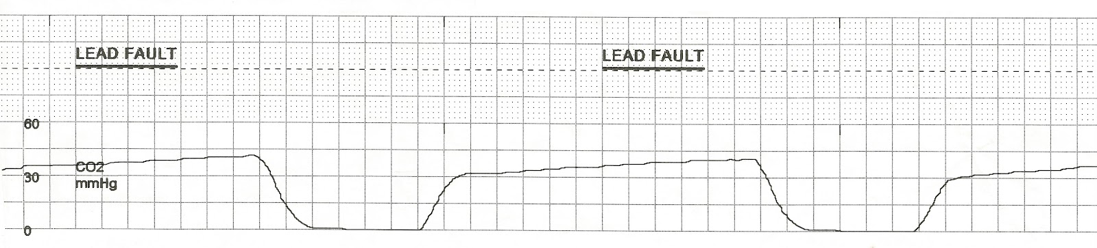 Float Nurse: Continuous Waveform Capnography