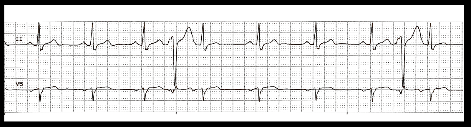 Practice EKG Strips 322