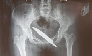 Deformutilation: Disturbing X-Rays