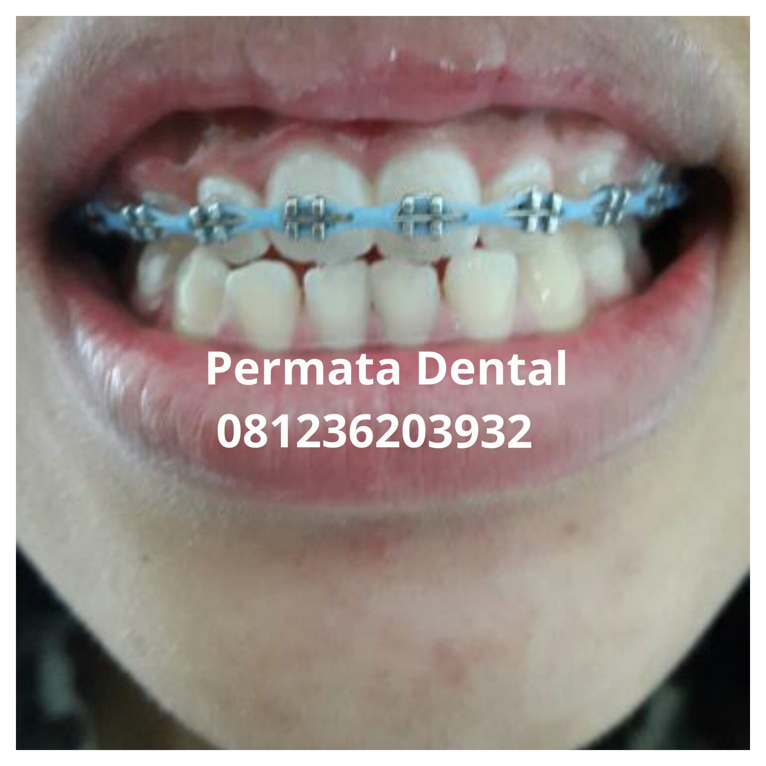 DOKTER GIGI BALI: Behel | Barcket | Kawat Gigi Perawatan