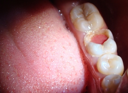 Chronic Hyperplastic Pulpitis ( Pulp polyp )