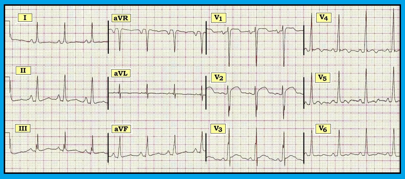 ECG Interpretation: ECG Interpretation Review #51 (Chamber Enlargement ...