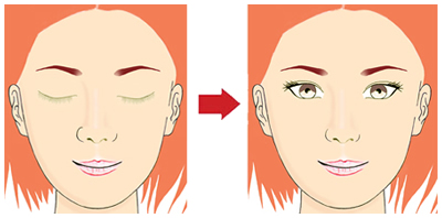Alar Base Reduction - Reduce nose wings