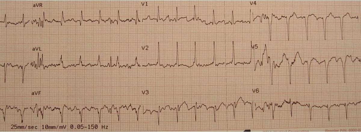 Dr. Smith's ECG Blog: Respiratory Failure, Heart Failure, and Narrow ...