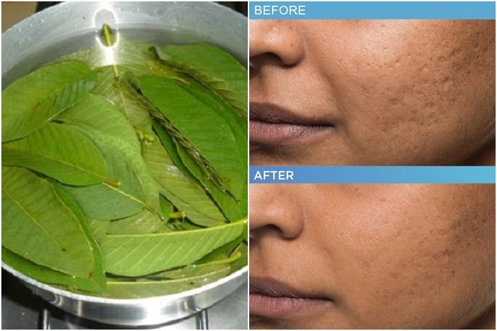 😱 Guava leaves for skin. 15 Surprising Benefits of Guava Leaves. 2022-10-26