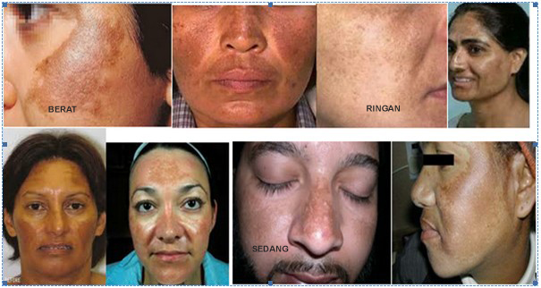 MELASMA KELAINAN PIGMEN KULIT ~ Kartika Skin Care