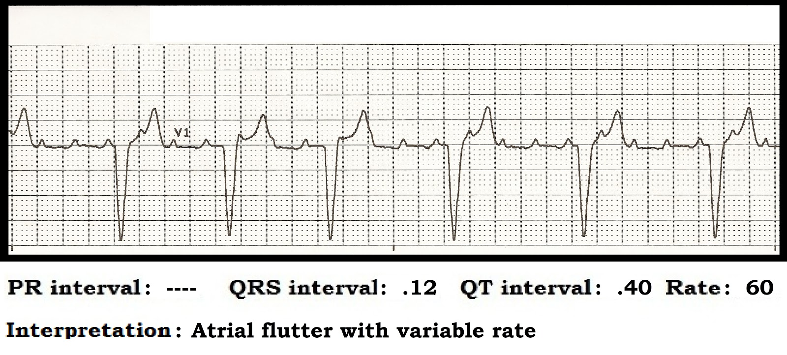Float Nurse: ECG Rhythm Strip Quiz 89: Interval measurements