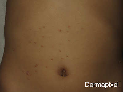 Dermapixel: junio 2018