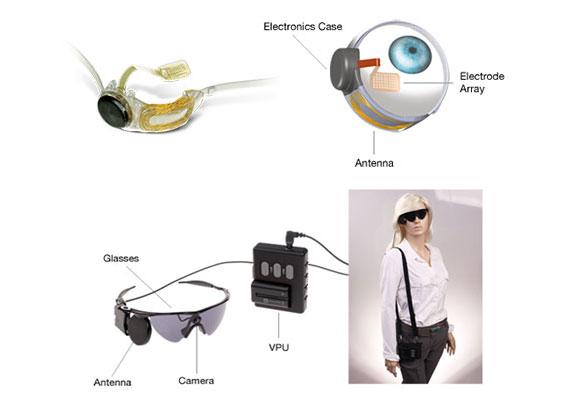 RETINAL PROSTHESIS - SwitchBoard - VisionResearch4You