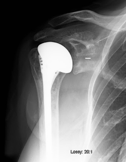 Shoulder and Elbow Surgery: Shoulder replacement for rheumatoid ...