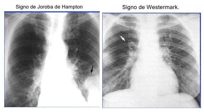 ¿Sabemos leer una RX de tórax? Parte 2: Principales signos radiológicos.
