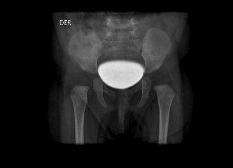 Tecnicos Radiologos: ¿Hay que colocar el Protector gonadal pediátrico ...