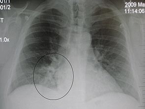 Fisio Home Care: Pulmão Humano - Patologia: Pneumonia