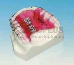 DISEÑAR LOS PATRONES DE APARATOLOGIA: PLACA DE HAWLEY CON TORNILLOS Y ...