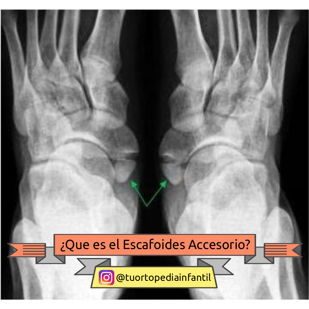 ¿Que es el escafoides accesorio?