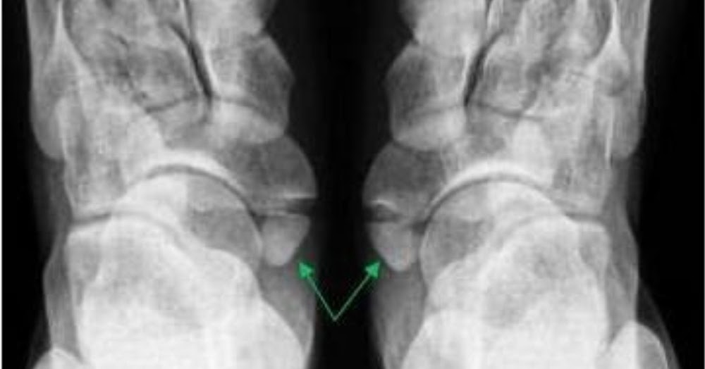 ¿Que es el escafoides accesorio?