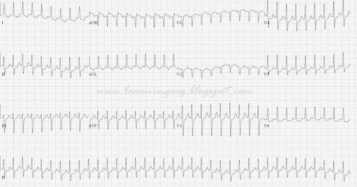 ECG Rhythms: A Supraventricular Tachycardia