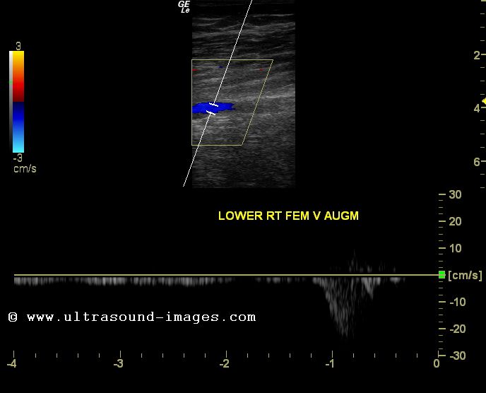 Deep-vein thrombosis- before and after treatment: ~ Ultrasound Cases Info