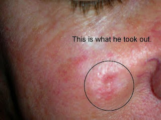 Jayaruh's Blog: Skin Cancer