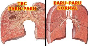 Obat Tbc Dan Keluhan Paru Paru