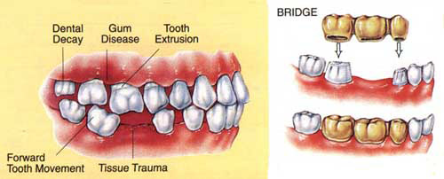 ASIF DENTAL CARE CENTRE: crowns and bridges