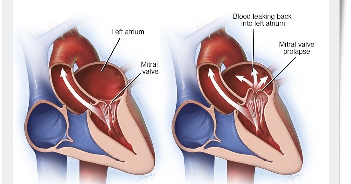 Enfermagem atualizada...: PROLAPSO E REGURGITAÇÃO DA VÁLVULA MITRAL