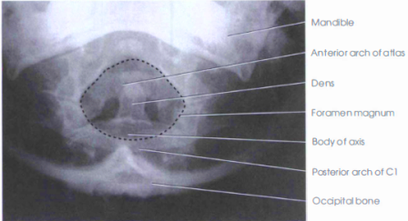 Fuchs Method AP Cervical Spine | Radiology Basics | Radtechonduty