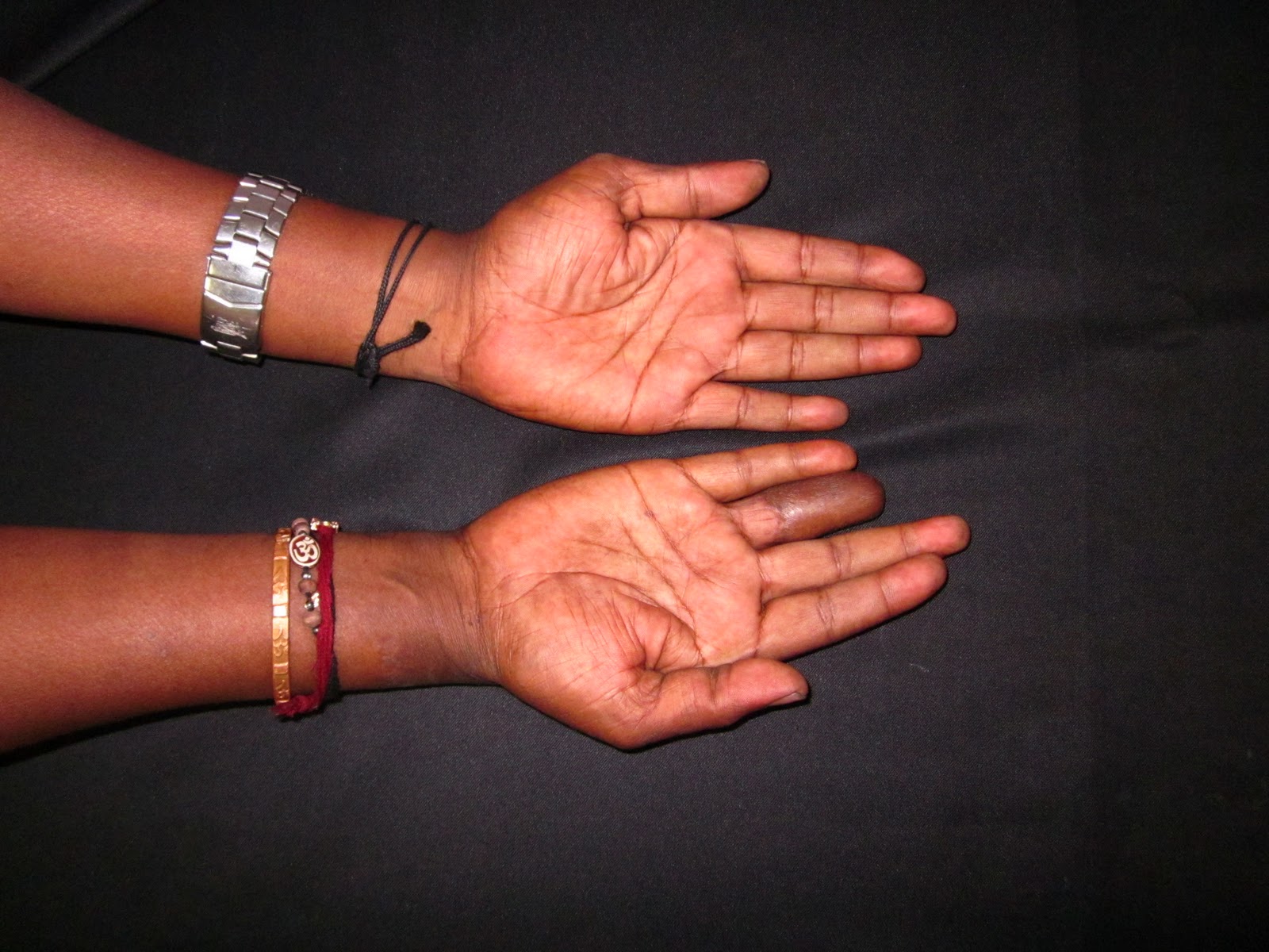 Crushing Injury Of Finger at Shelly Hampton blog