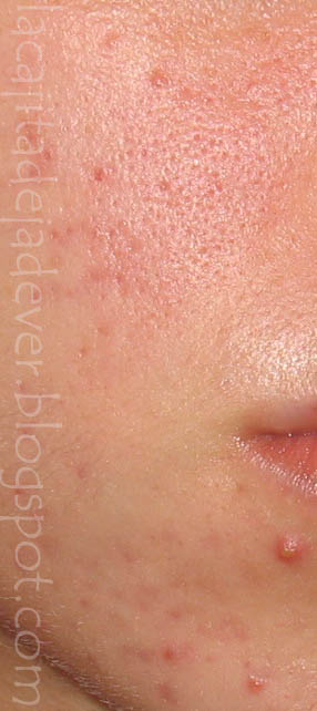 La cajita de Jade verde: Diario de una piel con acné-rosácea (III ...