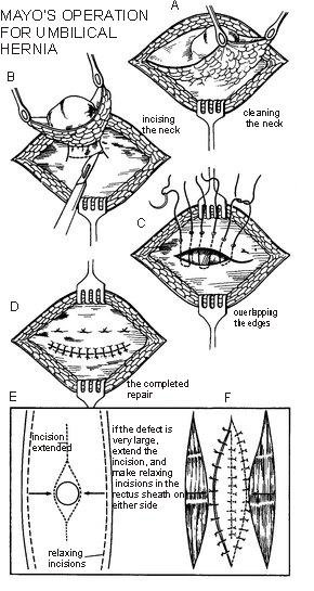 Notes on Umbilical Hernia Operation - @364