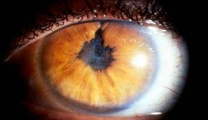 On Eye Care: When the body attacks the eye!