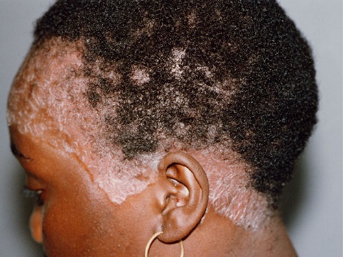 Treatment of Psoriasis of the Scalp! - The Best Treatment for Psoriasis!
