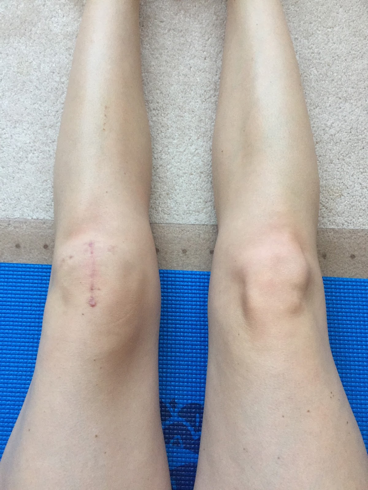 Megan's ACI Carticel Surgery: 3 1/2 Months Post Op