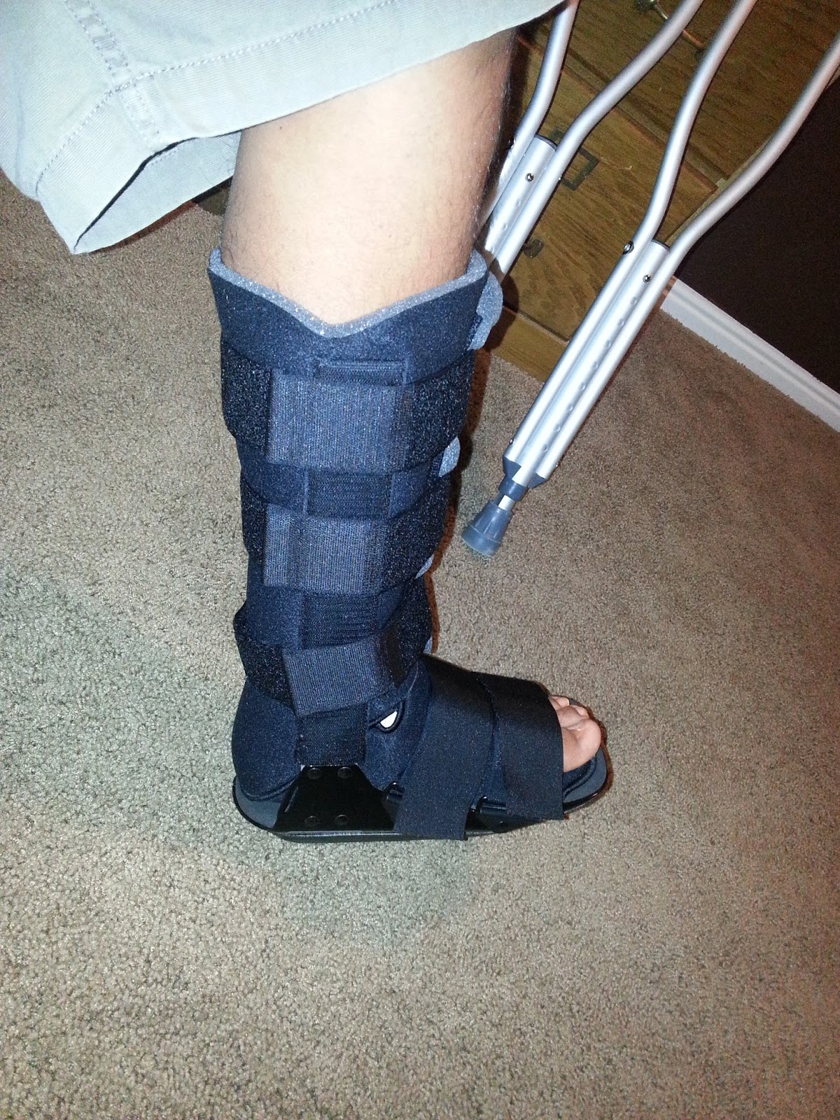 Peroneal Tendon Surgery Recovery: Week 2 - First Post-Op Visit