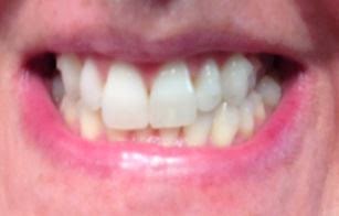 My Invisalign Chronicles: Week 5 - Tray Set 3 & Progress Update