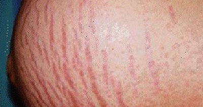 Quitar las estrias rojas en la piel: síntomas y signos