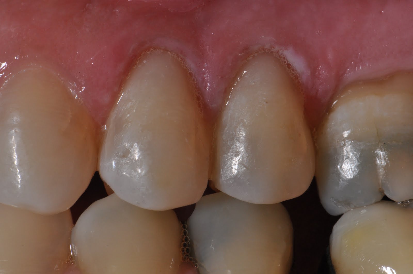 M. Vestphal - Odontologia Estética: Restauração Classe V com Resina ...