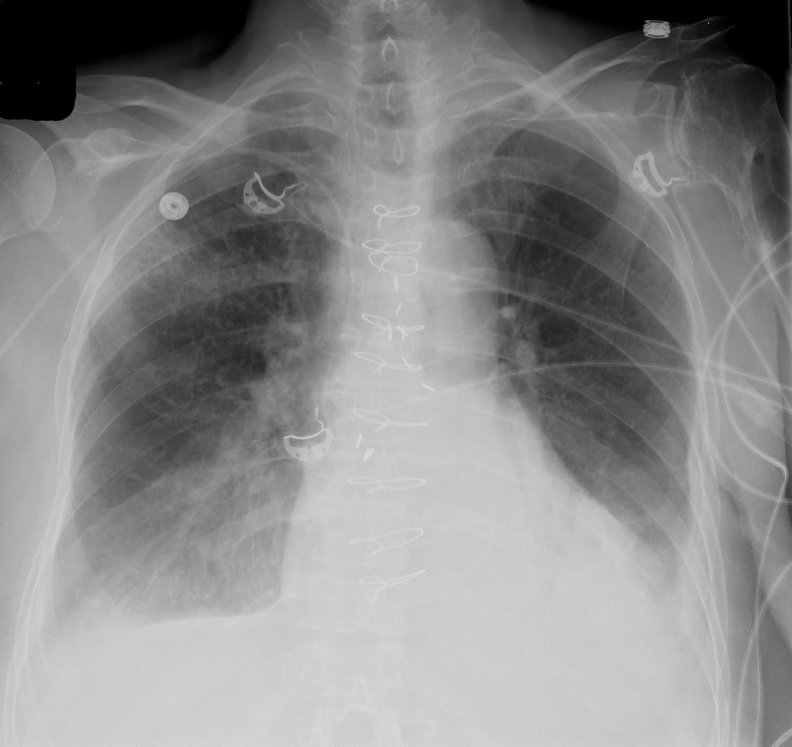 Topics in Radiography: Pacemaker Insertion
