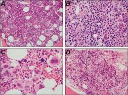 Medical Treatment Pictures-for Better Understanding: Polycythemia Vera
