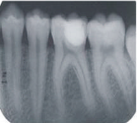 Management of the Deep Carious Lesion