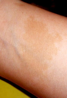 Café au lait spots - Café au lait macules | the dynamic natural skin care