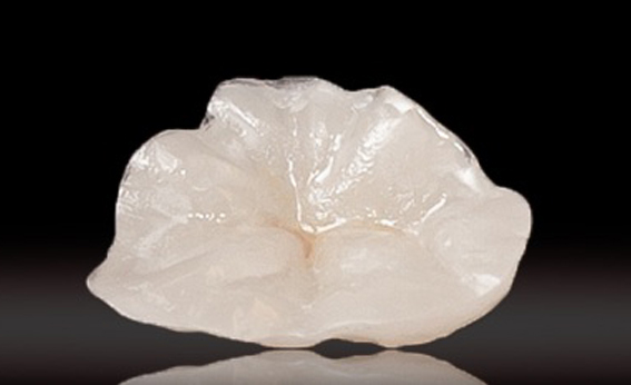 IPS Empress Inlays - VC-TECH Dental Laboratory