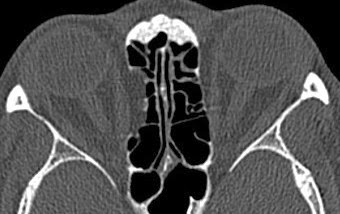 RADIODIAGNOSIS - IMAGE COLLECTION: Focal dehiscnece of lamina papyracea