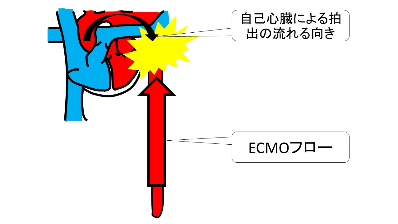ECMO（PCPS）の基本原理と観察項目-臨床工学技士による呼吸療法勉強会