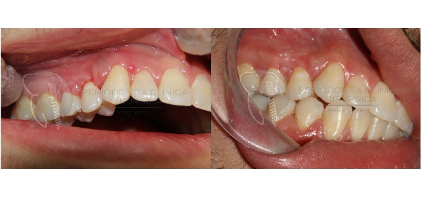 Retalho reposicionado coronalmente para recobrimento radicular: relato ...