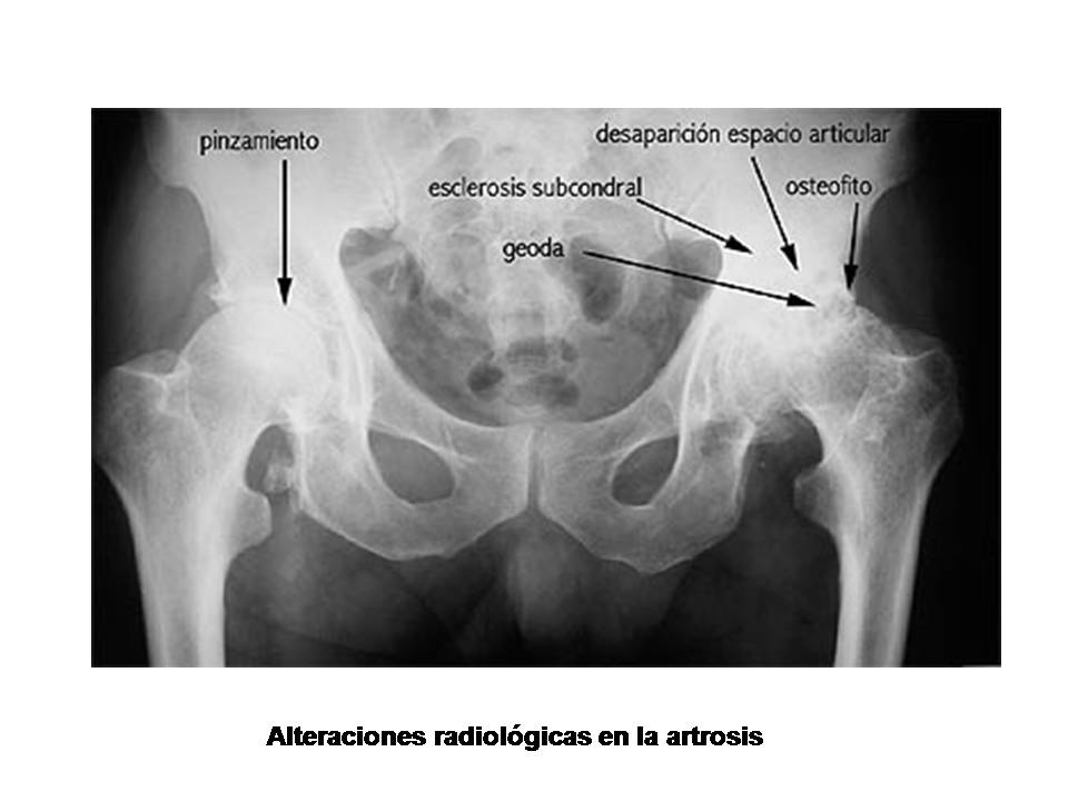 Diagnóstico de la artrosis
