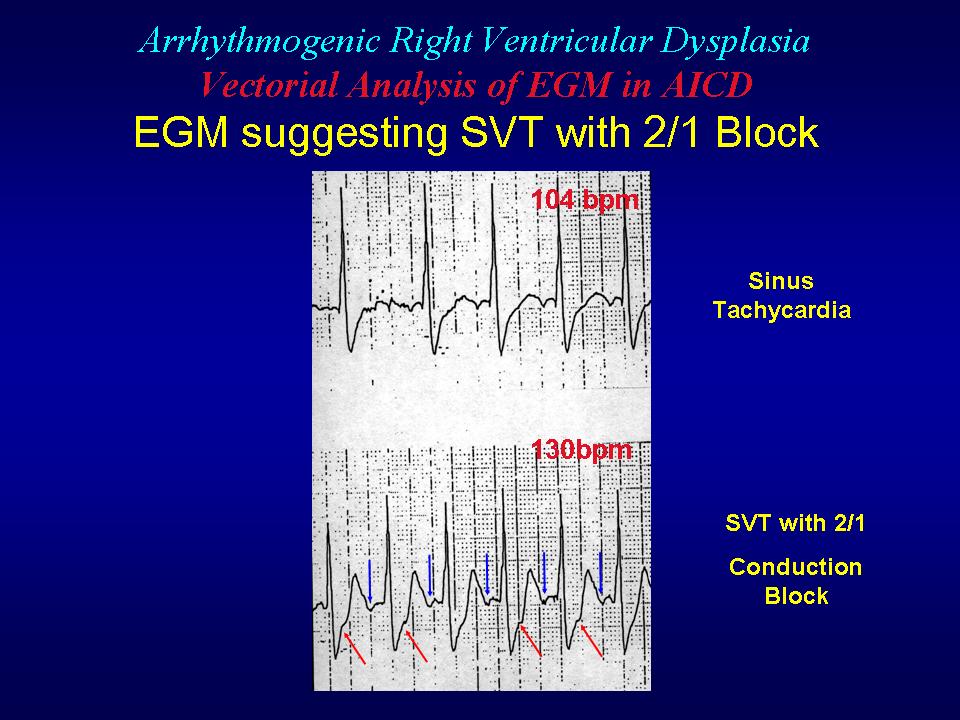 ARVCsGF: Vectorial interpretation of VT/SVT signals stored in the ICD