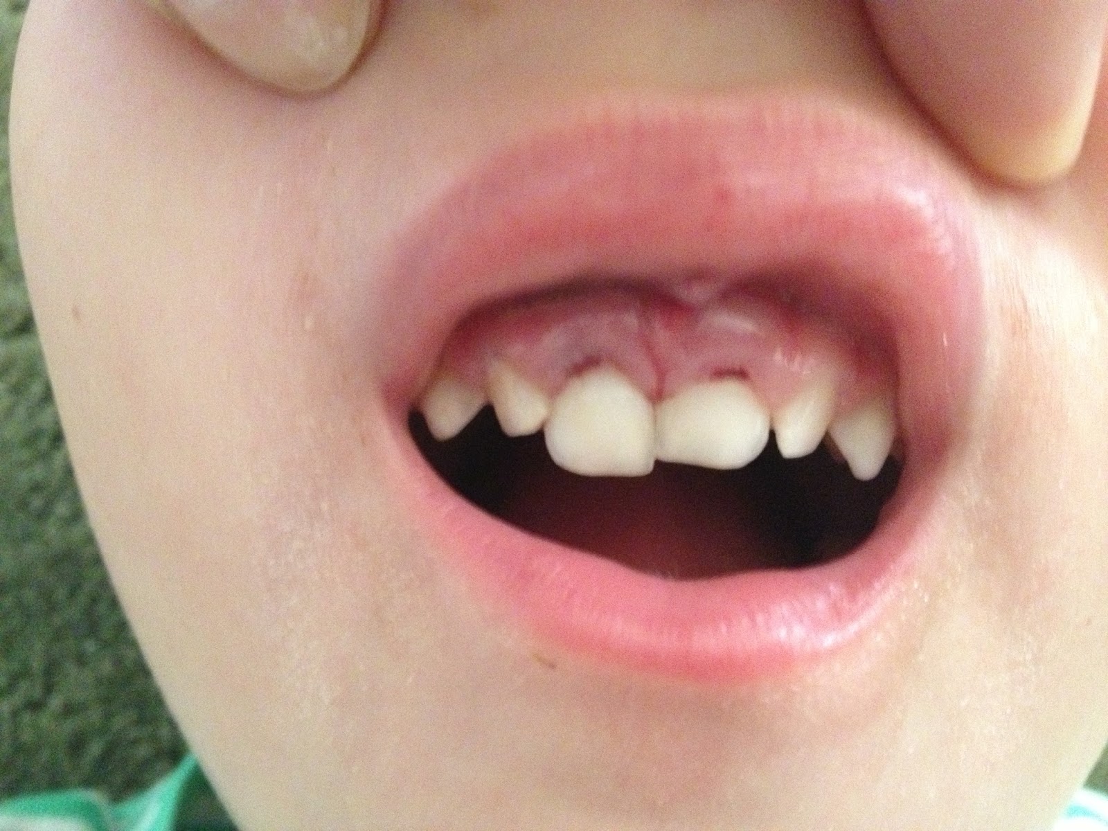 Daily Dimples: Mouth Trauma - Mater Tooth
