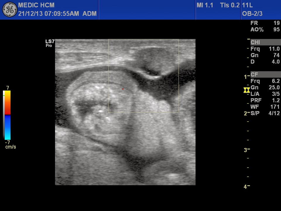 VIETNAMESE MEDIC ULTRASOUND: CASE 227: Umbilical Tumor, Sister Mary ...